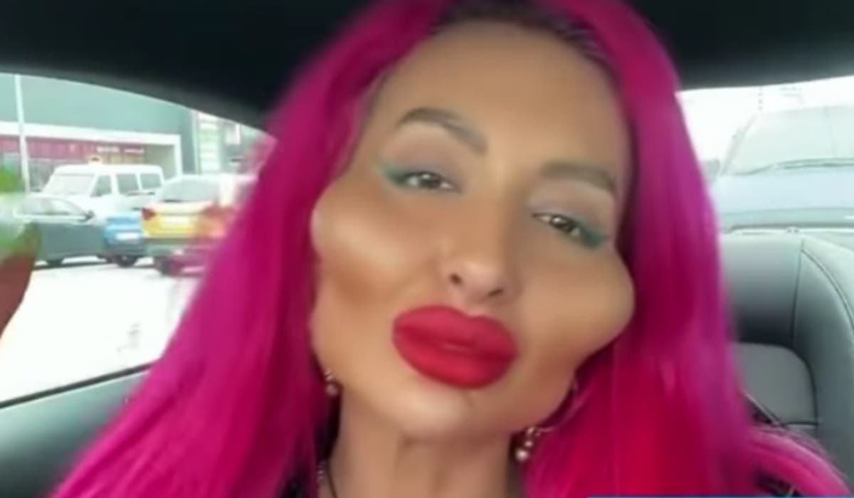 Este Femeia Cu Cei Mai Mari Obraji Din Lume, însă Nu Mereu A Arătat Așa ...