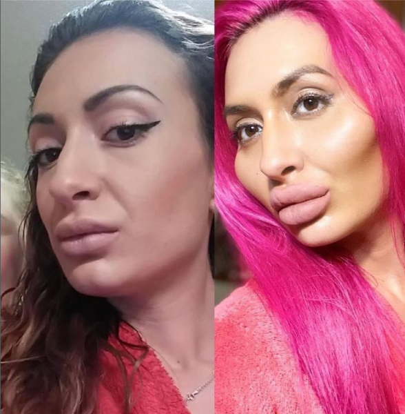 Este Femeia Cu Cei Mai Mari Obraji Din Lume, însă Nu Mereu A Arătat Așa ...